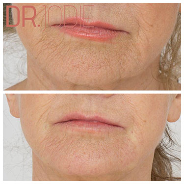 Chin Lines | Chin Fillers Melbourne | Dr. Jodie